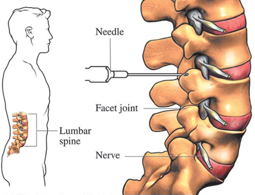 Facet Injections: Cervical, Thoracic and Lumbar - Pain management ...
